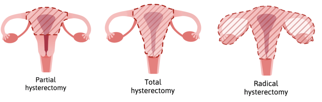 Hysterectomy: a new lease on life? - Maven Centre